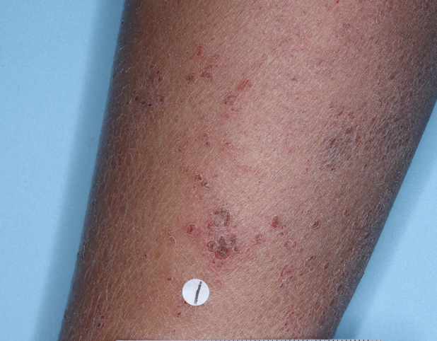 VTAMA® (tapinarof) cream, 1%