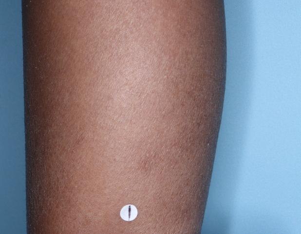 VTAMA® (tapinarof) cream, 1%