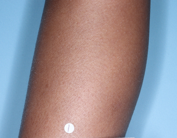 VTAMA® (tapinarof) cream, 1%