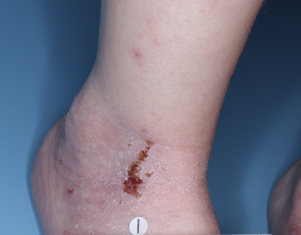 VTAMA® (tapinarof) cream, 1%