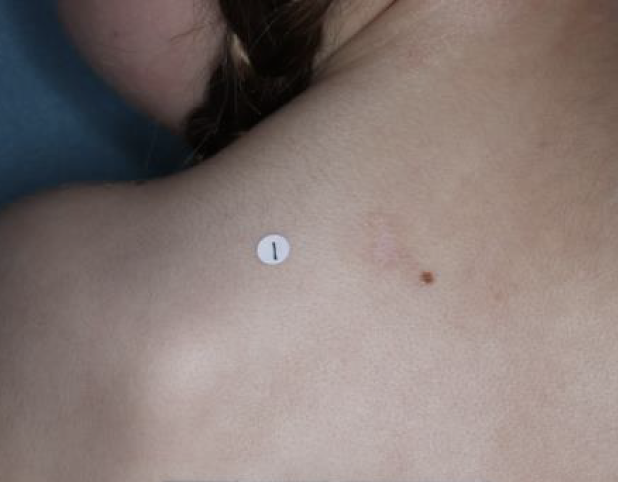 VTAMA® (tapinarof) cream, 1%